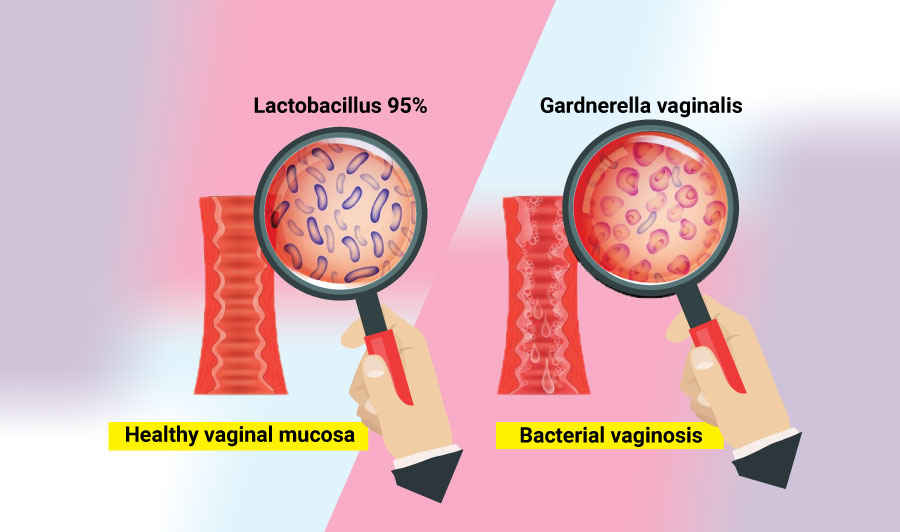 Bacterial Vaginosis | Dynamic Nutrition