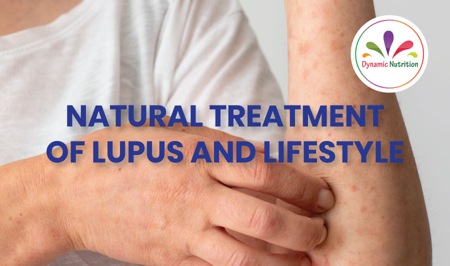 Natural Treatment Of Lupus And Lifestyle | Dynamic Nutrition